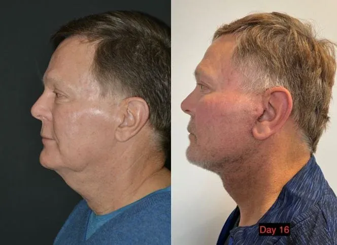 Lifting facial en hombres